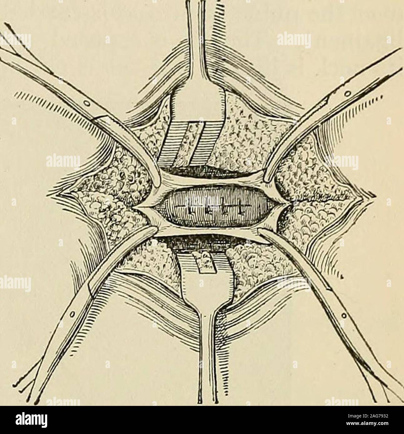 . Modern surgery, general and operative. Fig. 835.—Mayos operation for ...