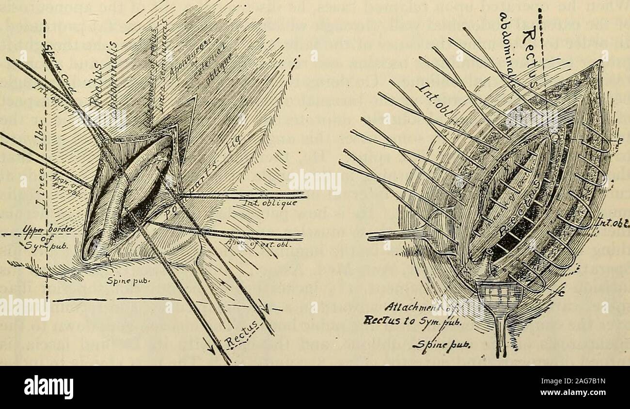 . Modern surgery, general and operative. Fig. 826.—Suture of the ...