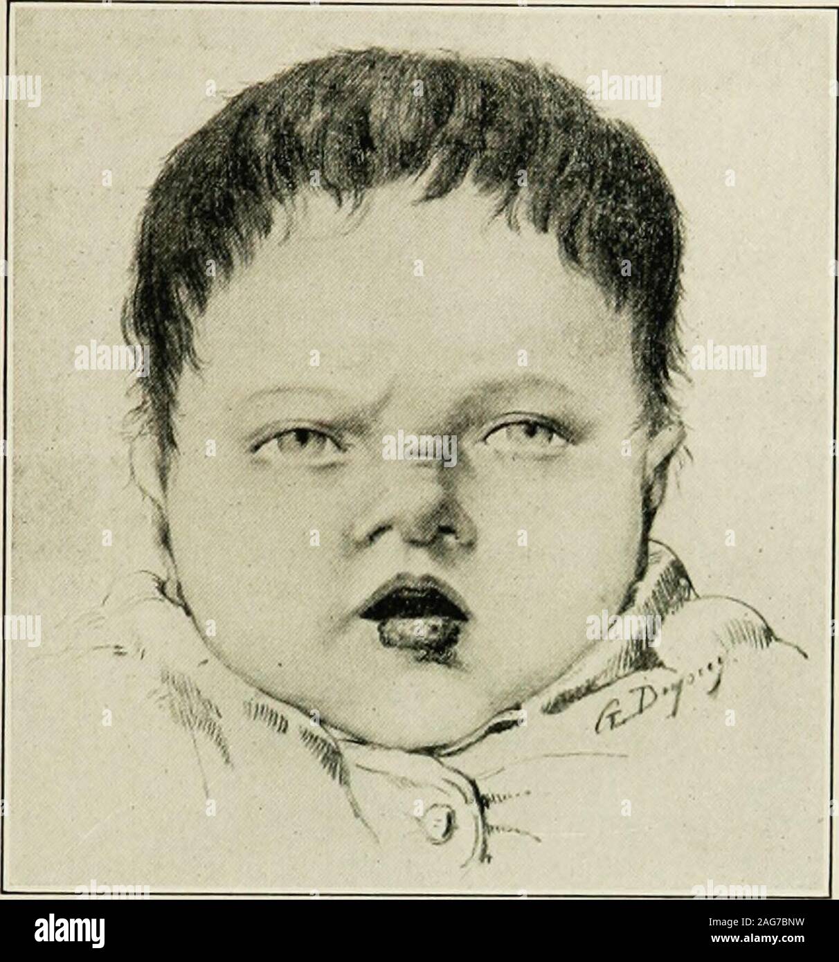 Syphilide hi-res stock photography and images - Alamy