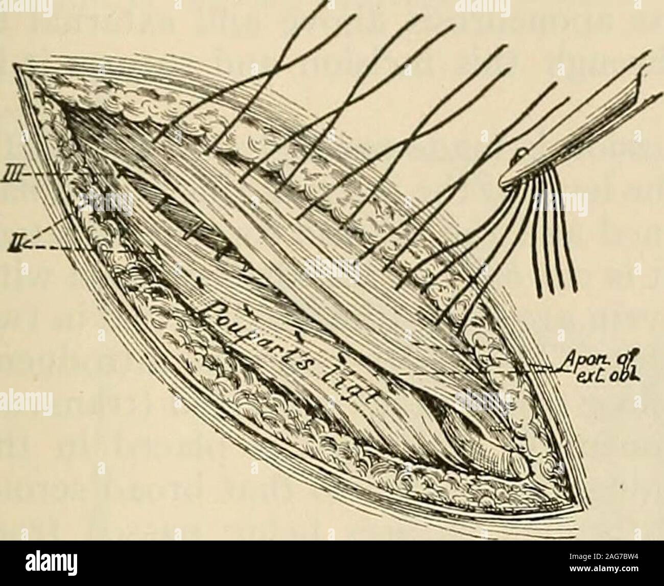 . Modern surgery, general and operative. tucked underthe edge of the ...