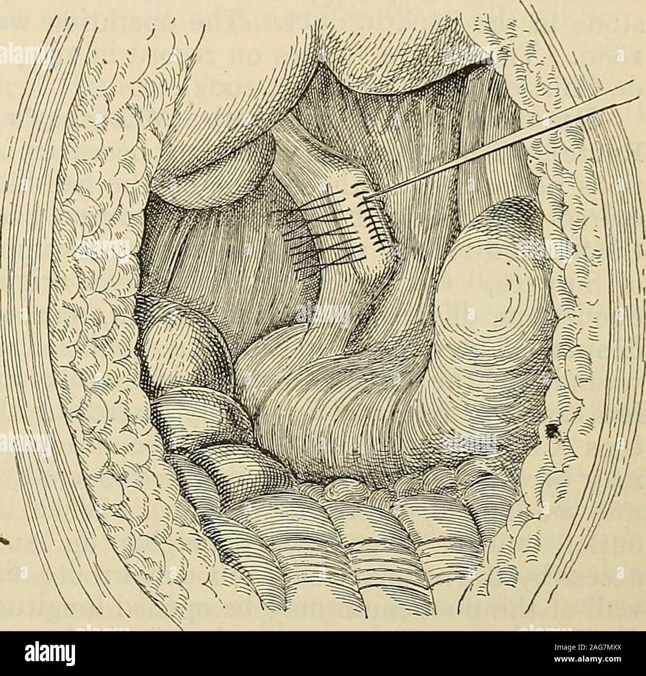 . Modern surgery, general and operative. this layer Lembert or ...