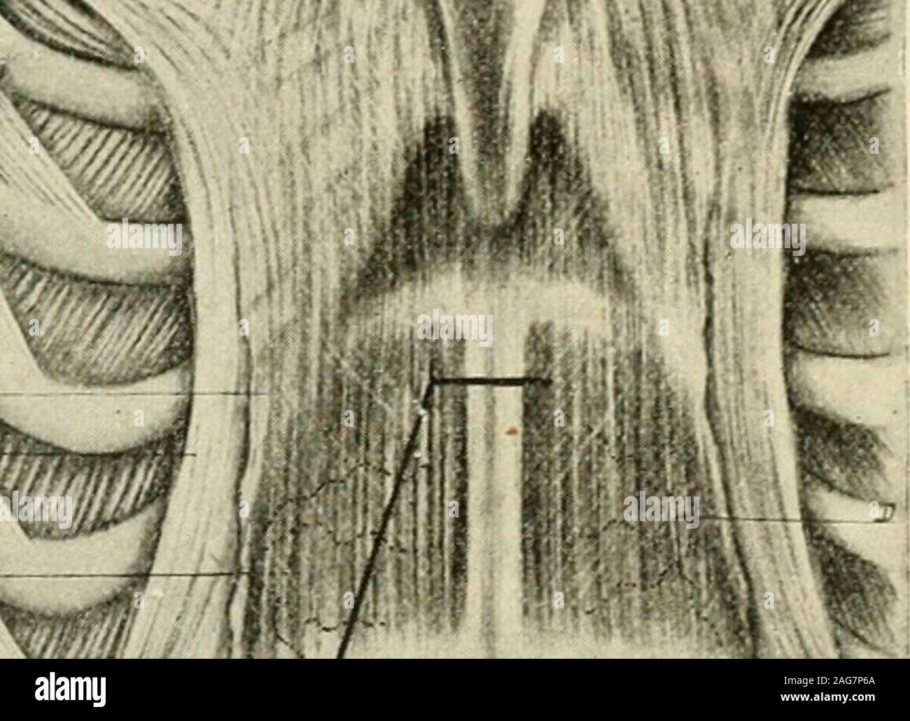 . Modern surgery, general and operative. Fig. 811.—A, Anterior wall of ...