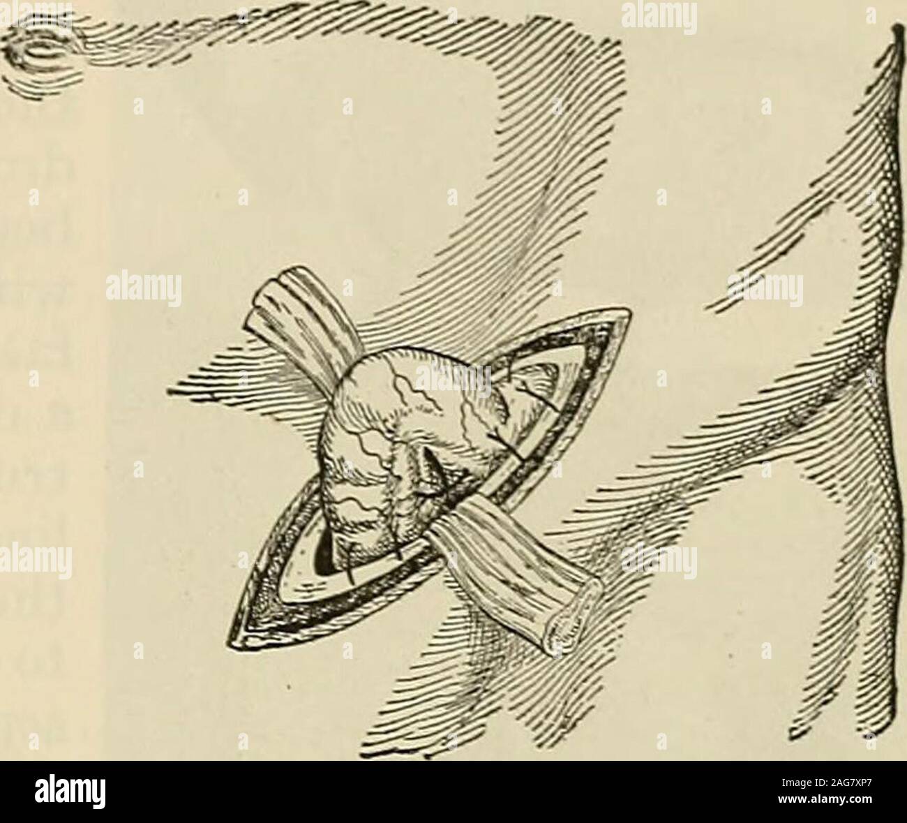 . Modern surgery, general and operative. Fig. 804.—Pauls tube. Fig. 805 ...