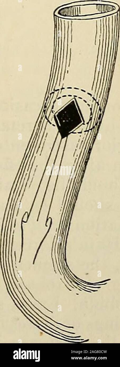 Sutures infected hi-res stock photography and images - Alamy