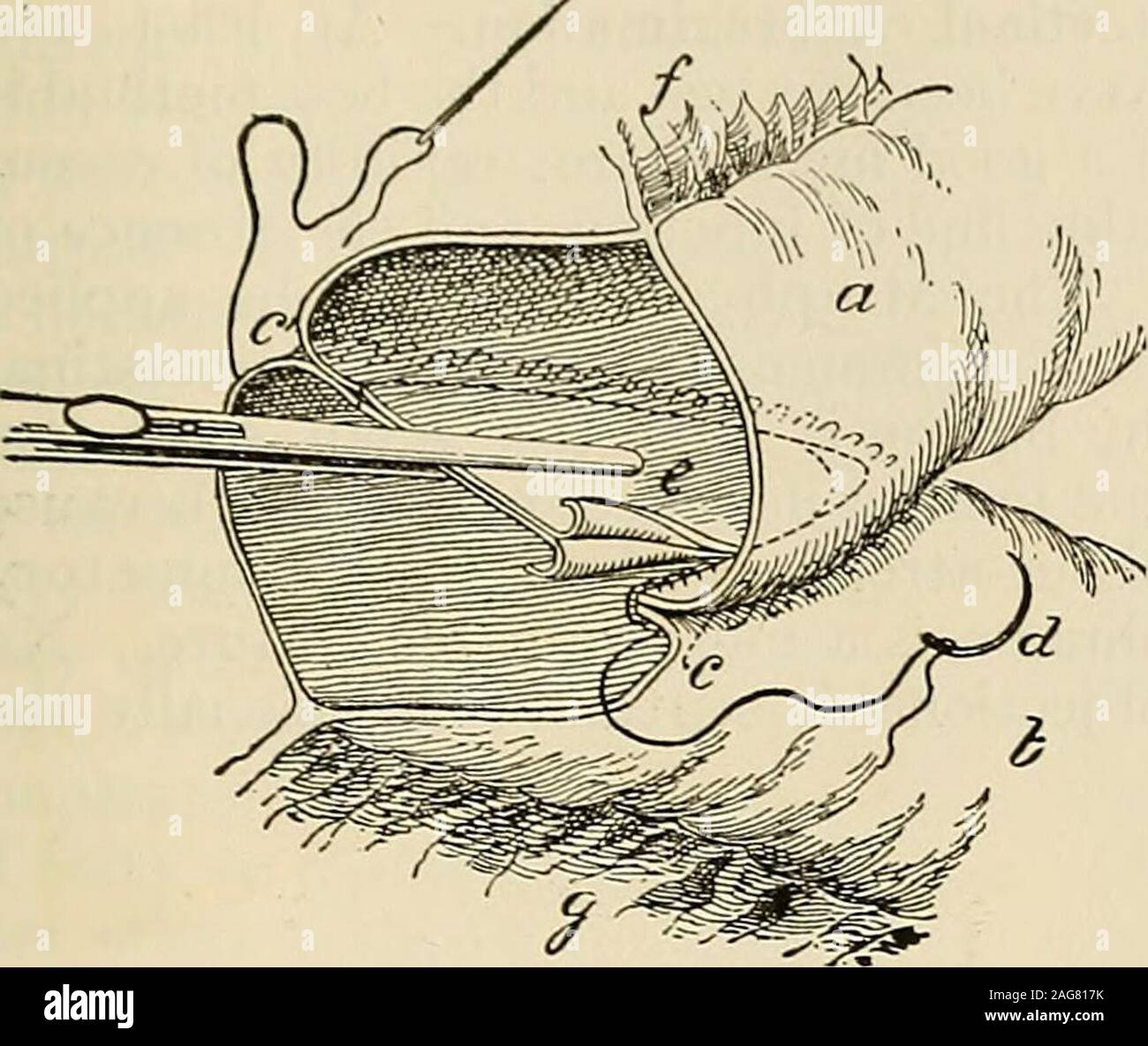 Bowel resection hi-res stock photography and images - Alamy