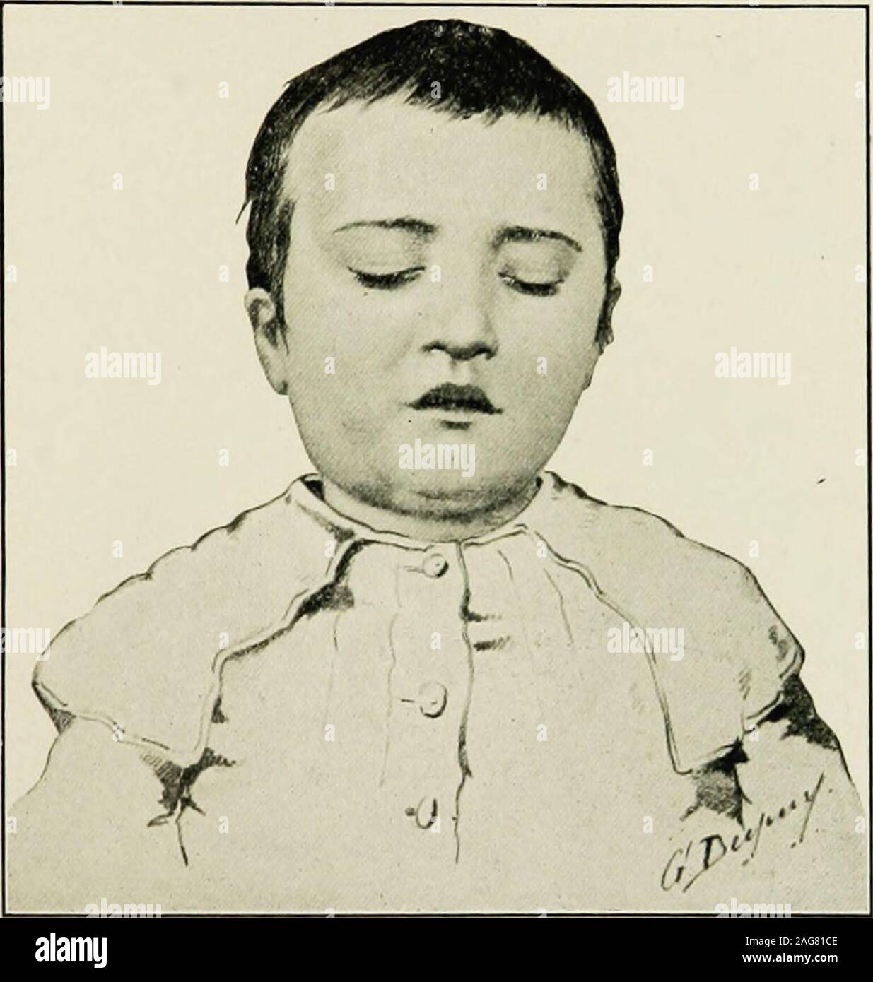 Induration hi-res stock photography and images - Alamy