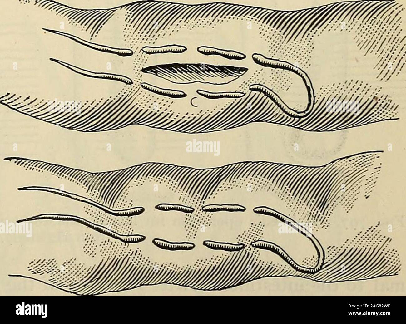 Intestinal anastomosis hi-res stock photography and images - Alamy