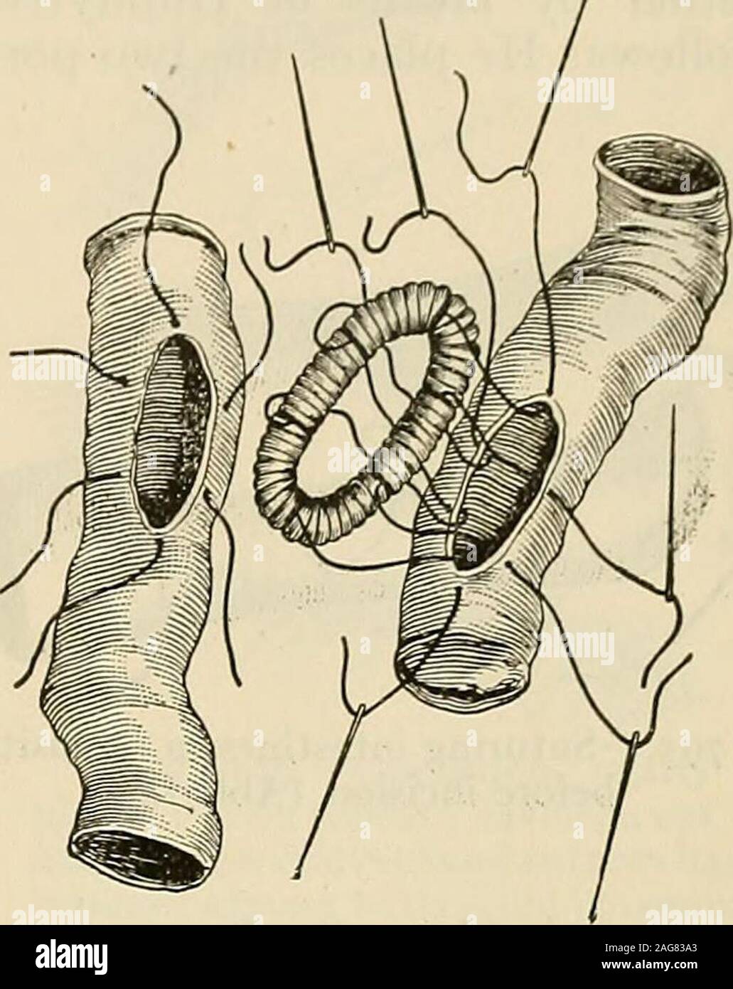 Bowel loop hi-res stock photography and images - Alamy
