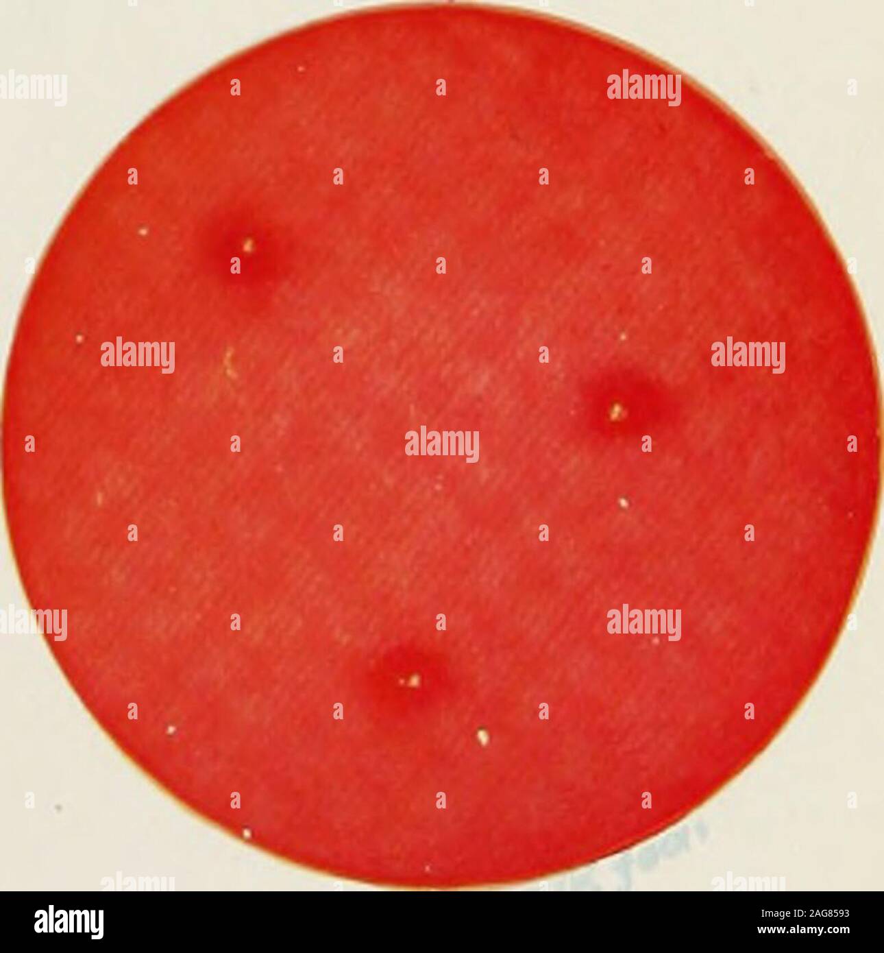 Koplik's spots hi-res stock photography and images - Alamy