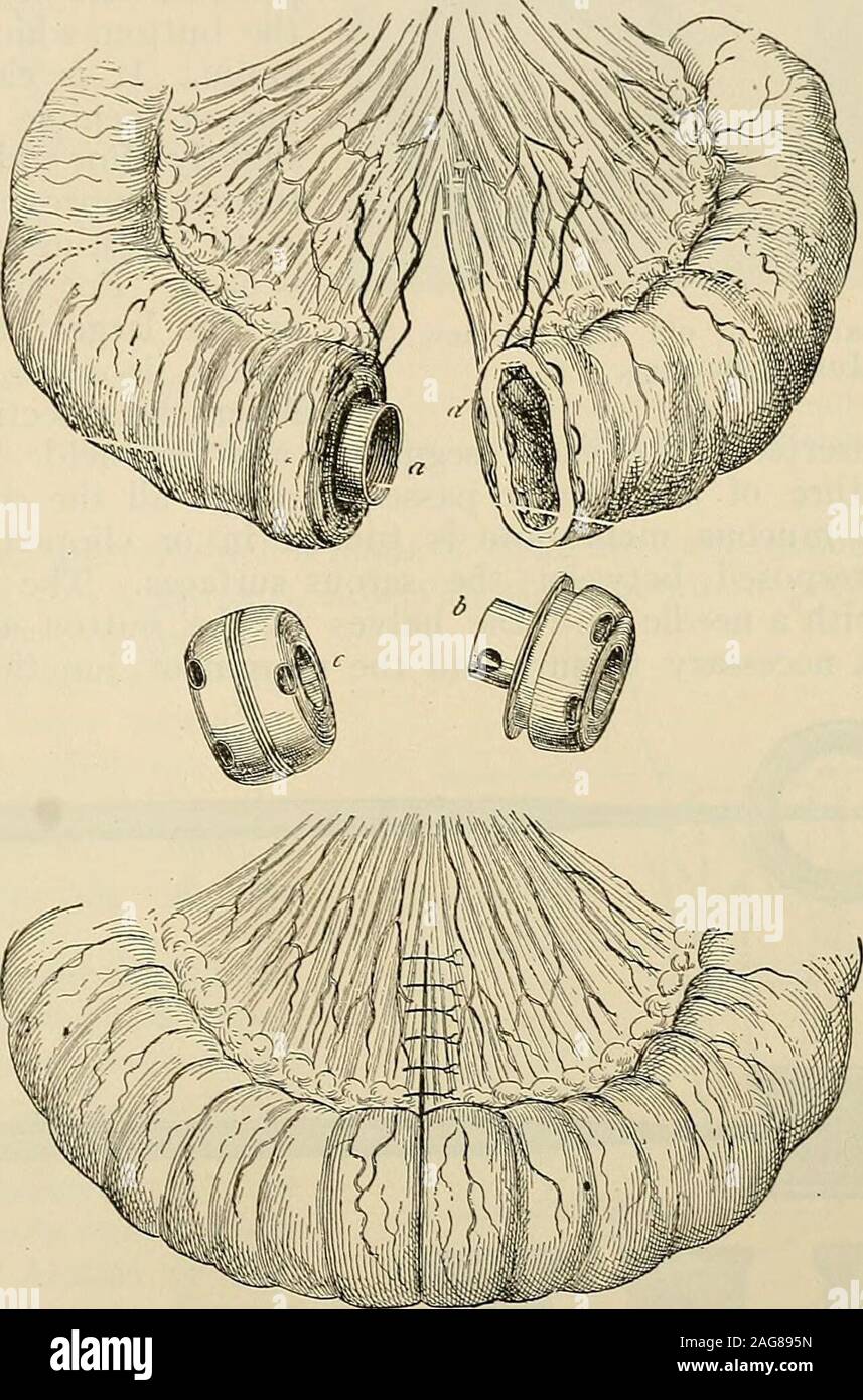 Constricted ring hi-res stock photography and images - Alamy