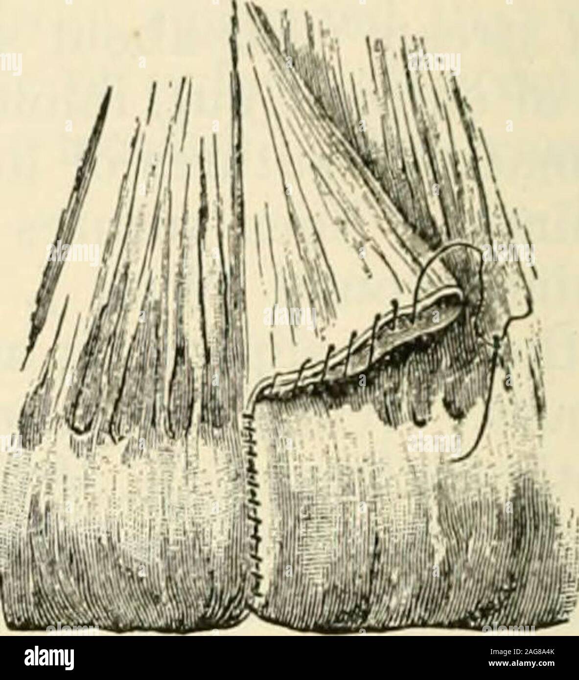 Blood vessel clamp hi-res stock photography and images - Alamy