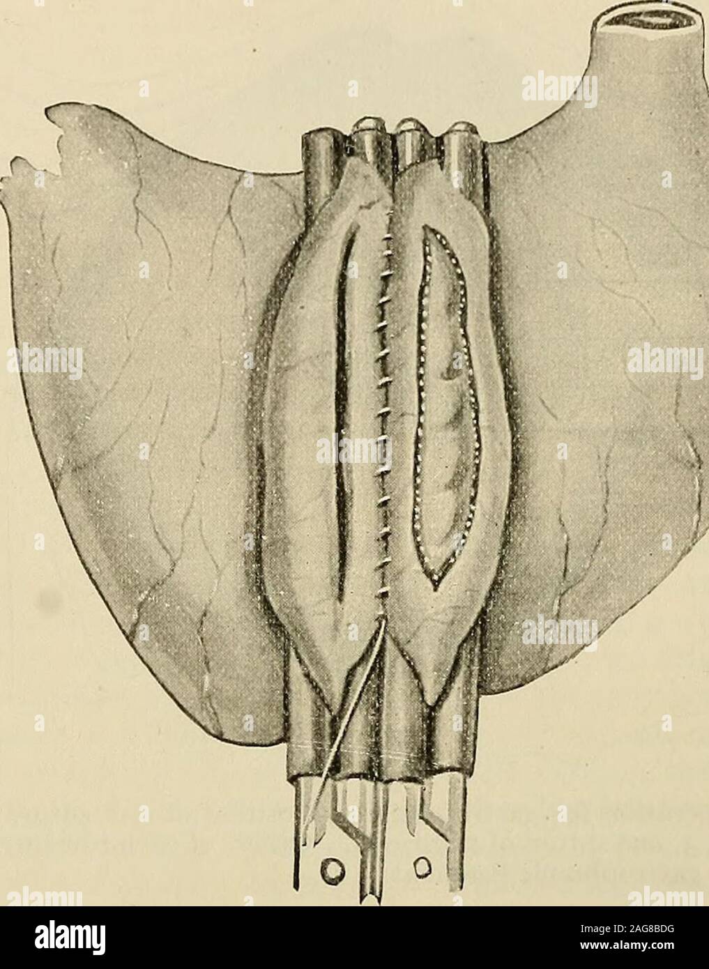 . Modern surgery, general and operative. Fig. 769.—Birchers method of ...