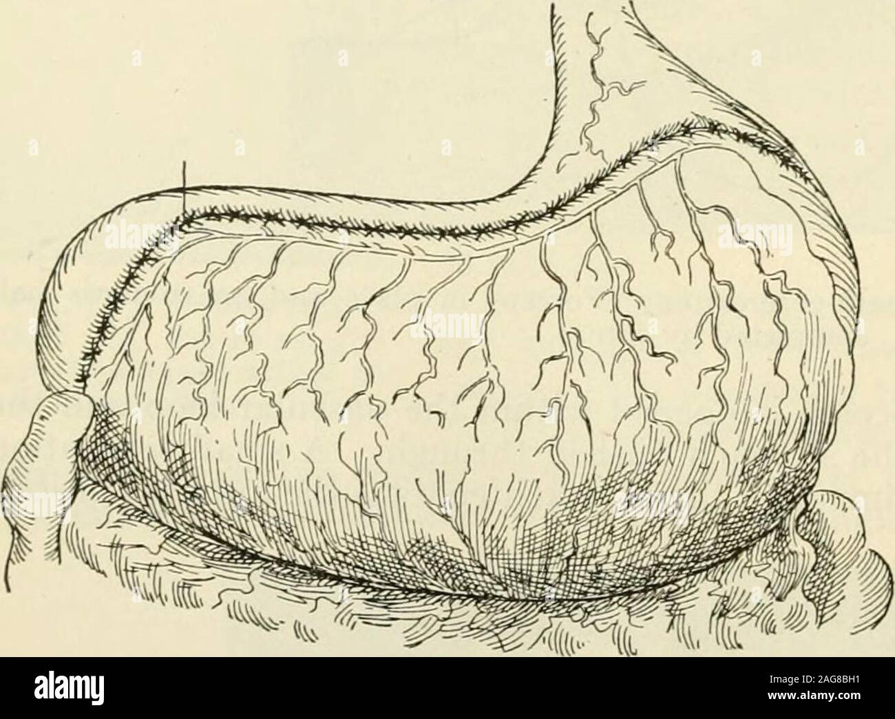 . Modern surgery, general and operative. en the two pouches. He makes ...