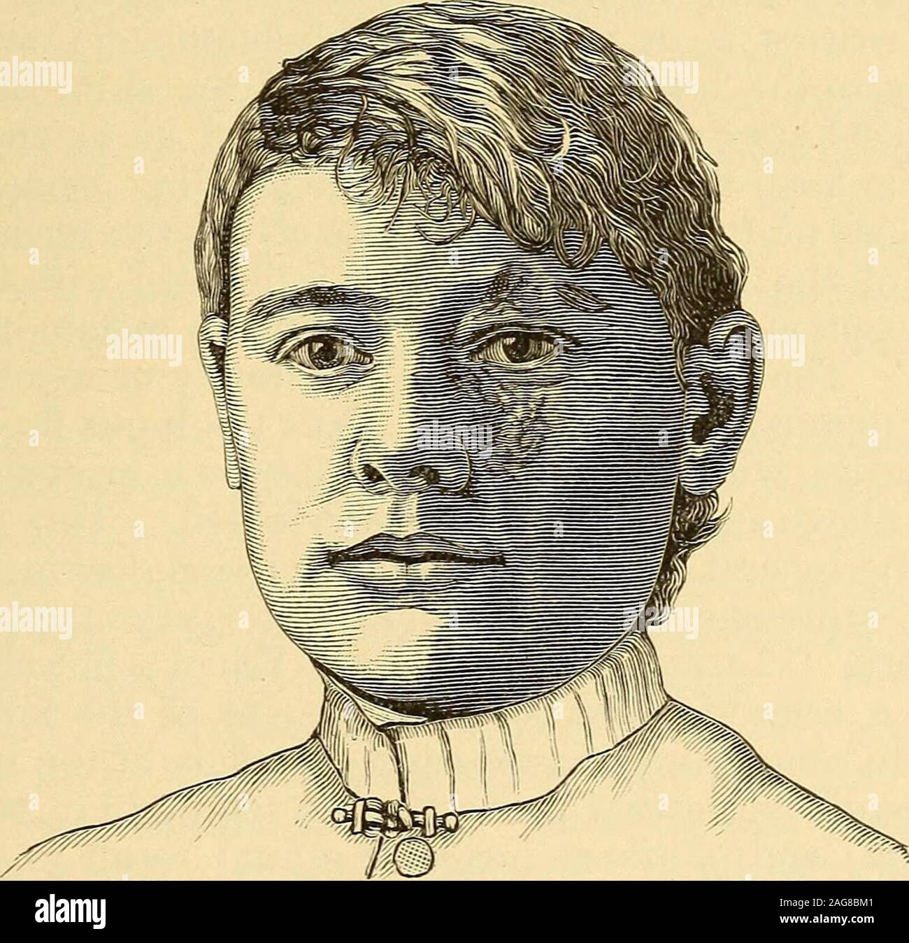 Scrofuloderma hi-res stock photography and images - Alamy