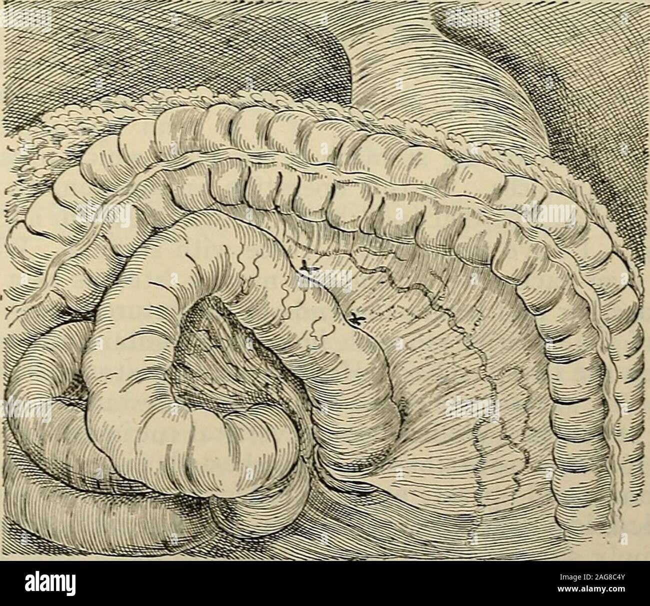 . Modern surgery, general and operative. Fig. 767.—Mayos method of ...