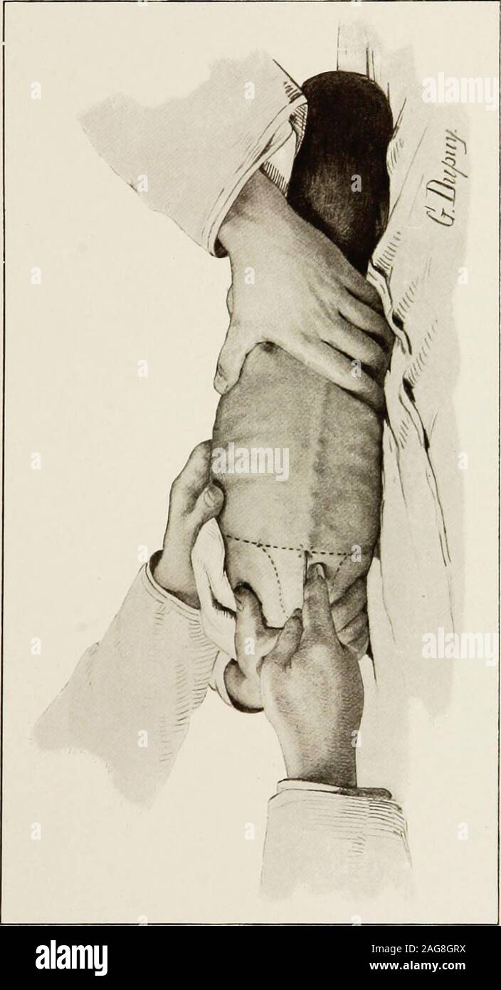 Pyelitis hi-res stock photography and images - Alamy