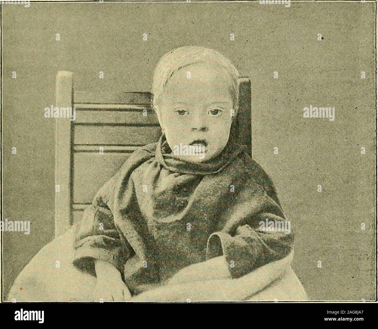 Microcephaly Pinhead