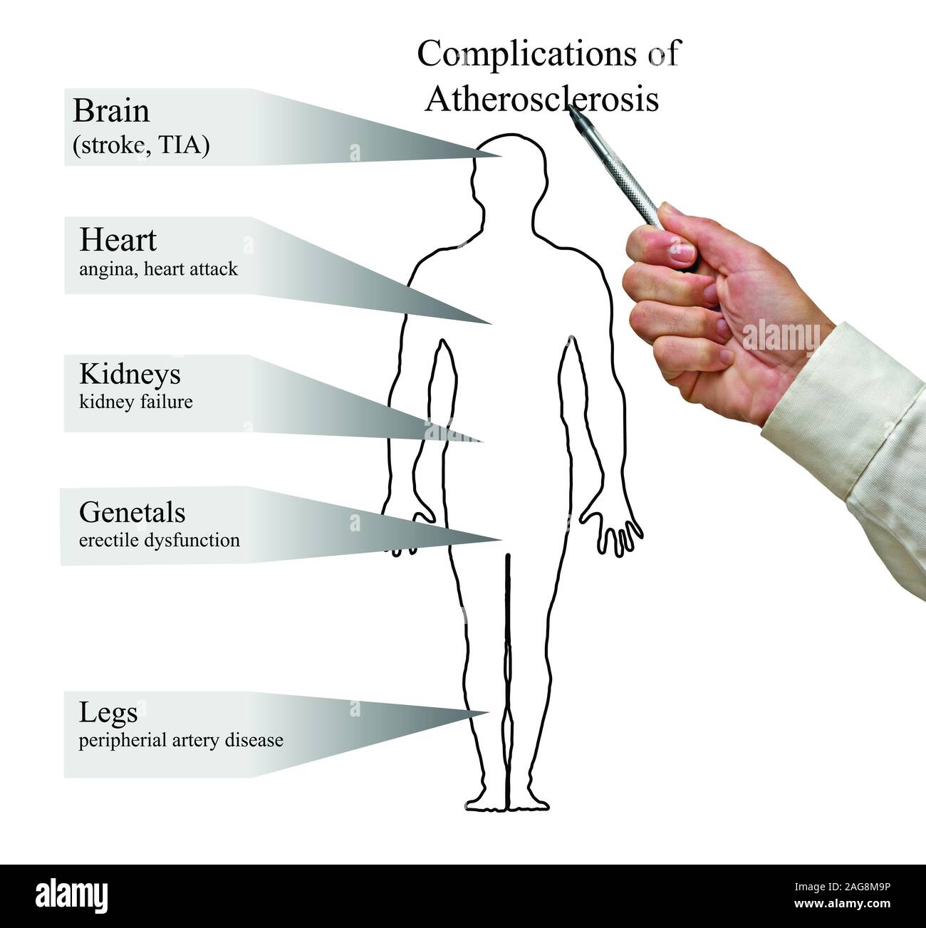 Complications of Atherosclerosis Stock Photo - Alamy