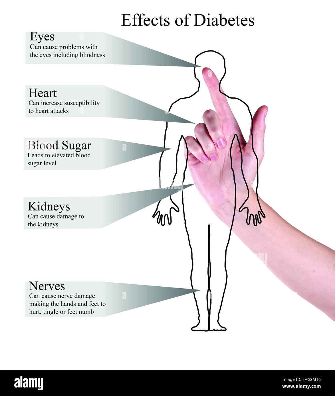 Effects of diabetes Stock Photo - Alamy