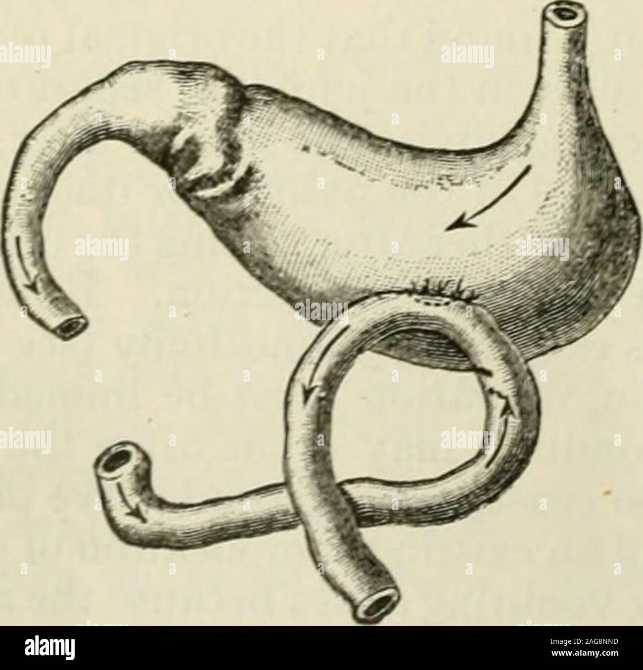 . Modern surgery, general and operative. Fig. 746.—Billrothsmethod of ...