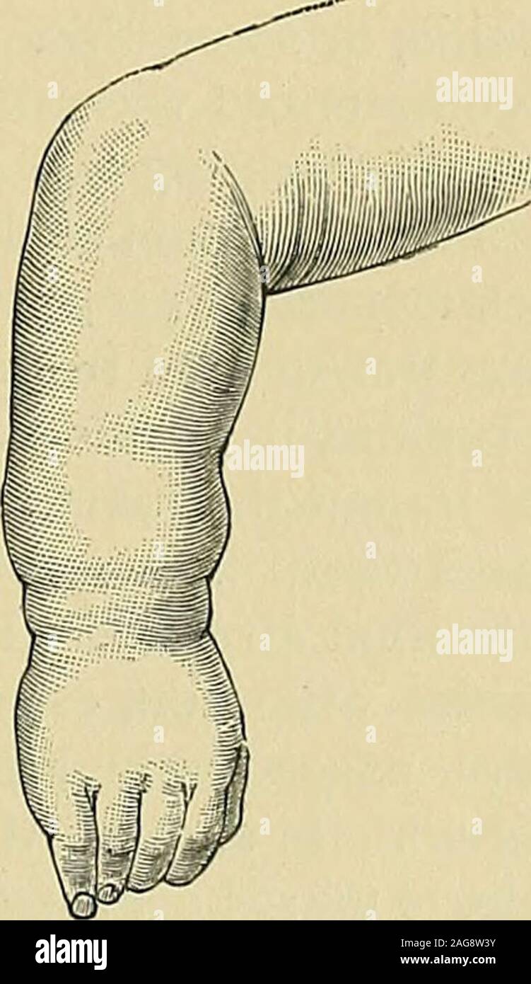 . The diseases of children : medical and surgical. Fig. 93.—Swelling of ...