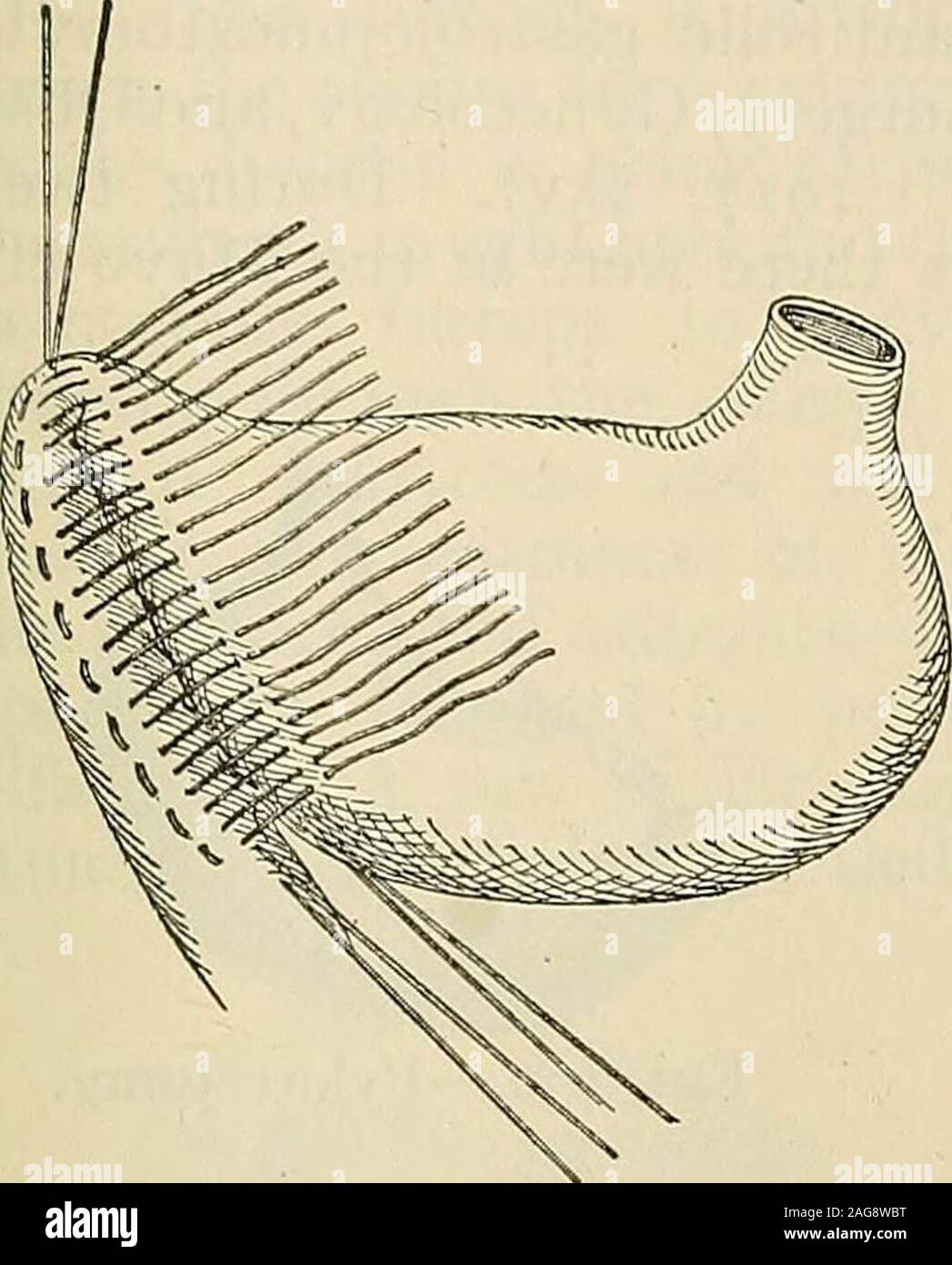 . Modern surgery, general and operative. Fig. 729.—Finneys pyloroplasty ...