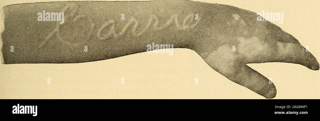 Erythema multiforme hi-res stock photography and images - Alamy