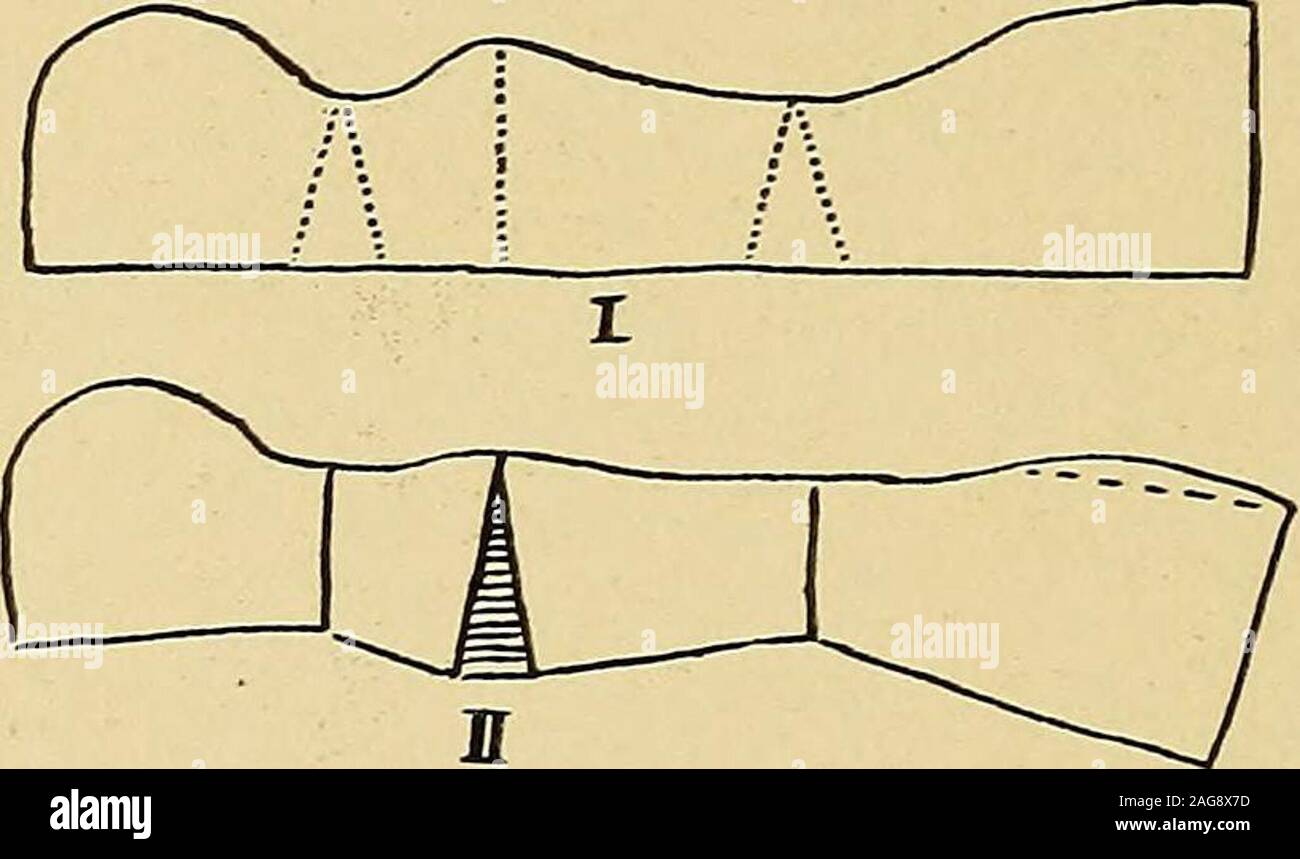 Orthopaedic plaster cast hi-res stock photography and images - Alamy