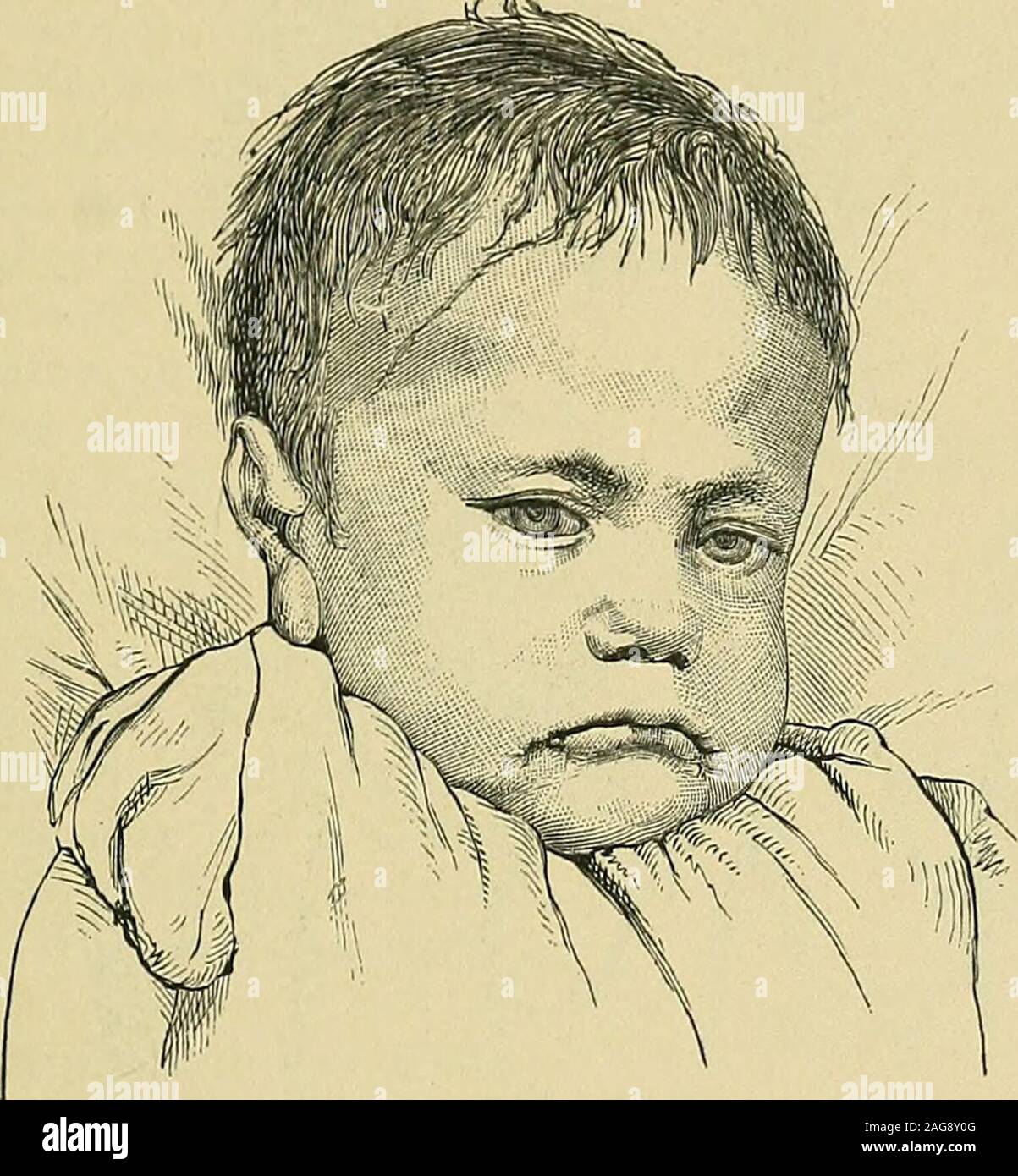 Erythematous rash hi-res stock photography and images - Alamy