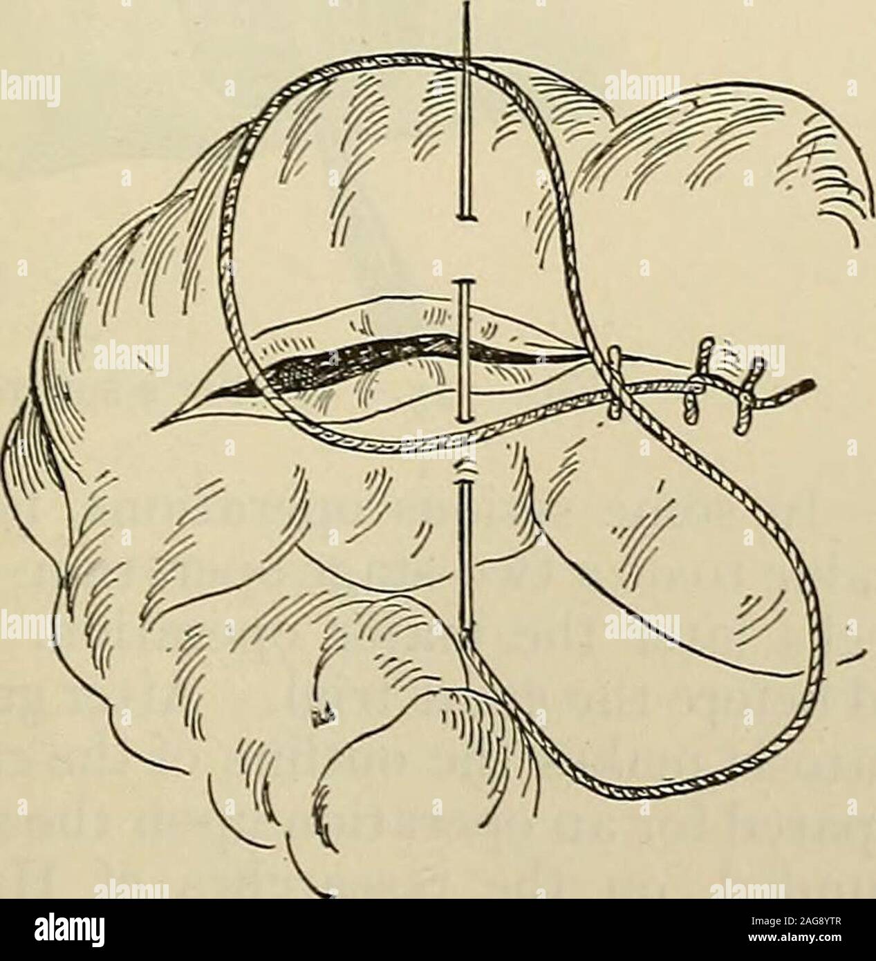 . Modern surgery, general and operative. Fig. 718.—^Lemberts suture ...