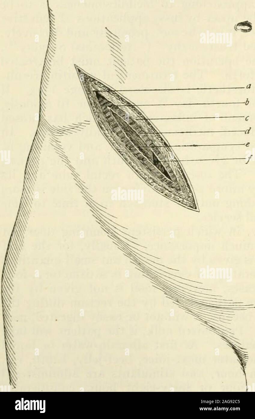 Mcburney incision hi-res stock photography and images - Alamy