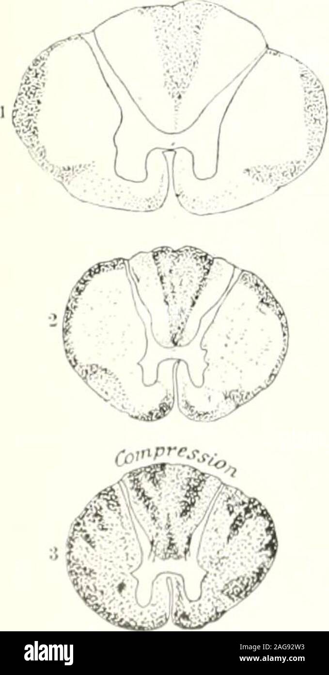 Syringomyelia Cross Section