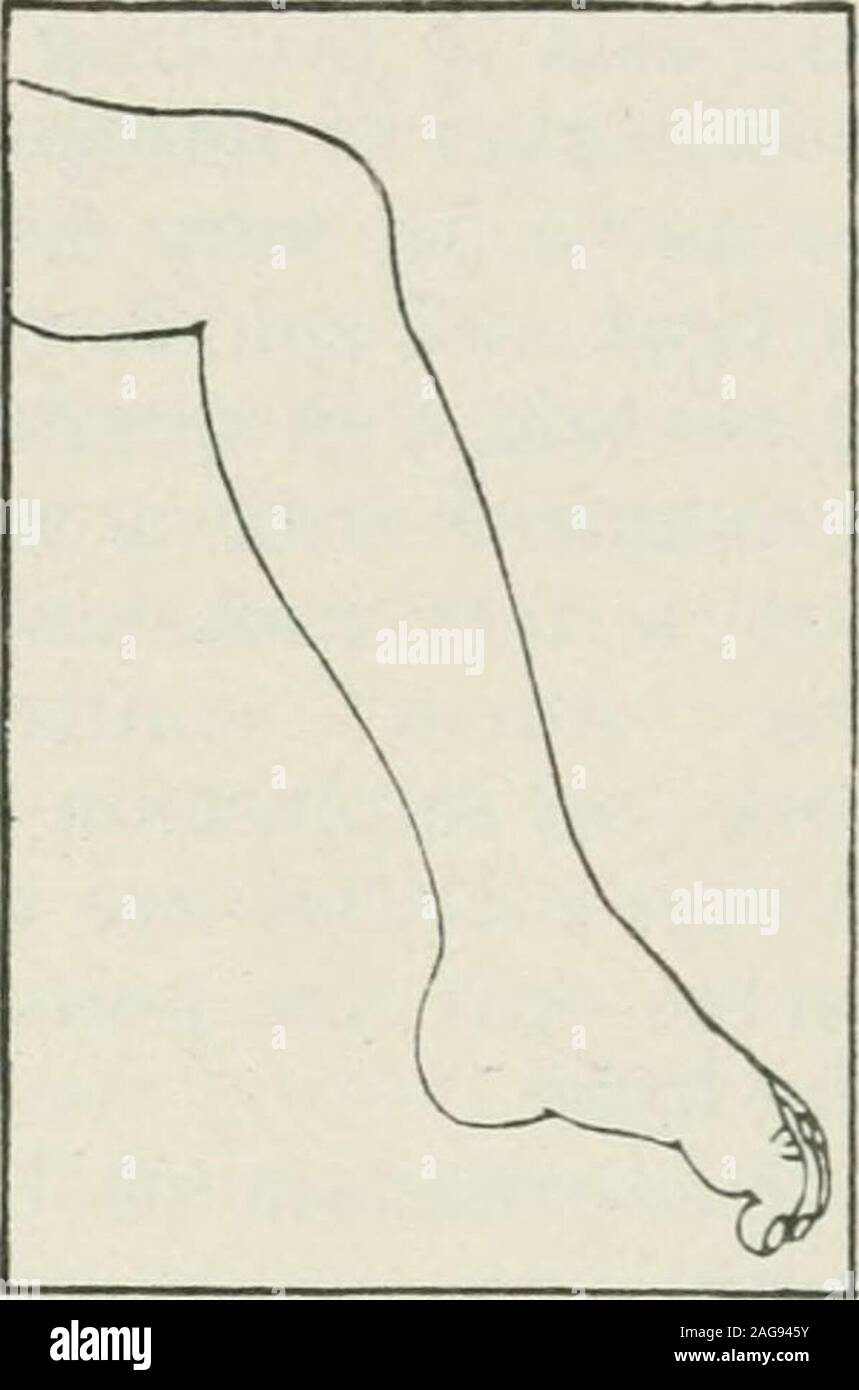 Foot Adduction