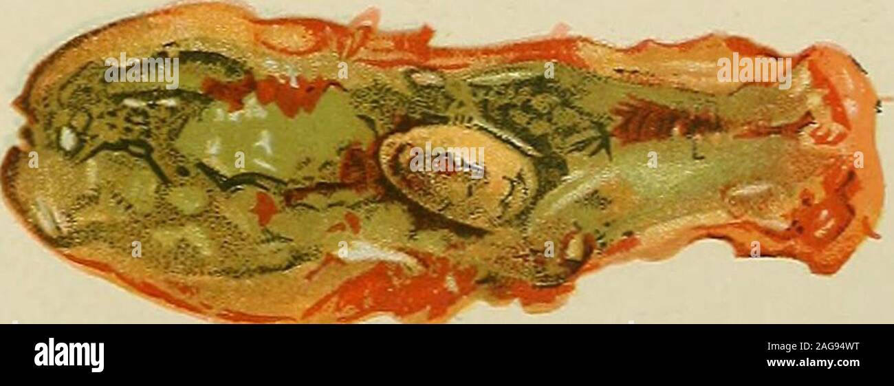 . Modern surgery, general and operative. Various forms of appendicitis ...