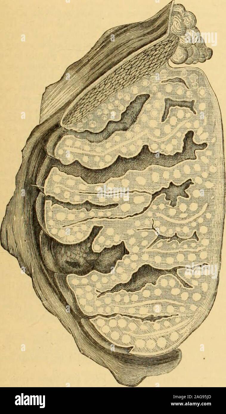 Enlarged tonsils hi-res stock photography and images - Alamy