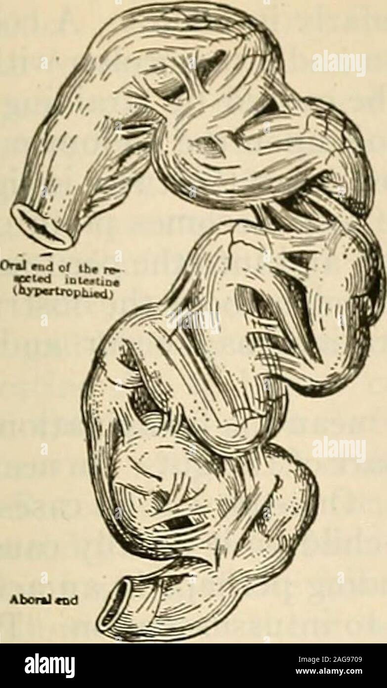 . Modern surgery, general and operative. Obstruction by Adhe-sions (Fig ...