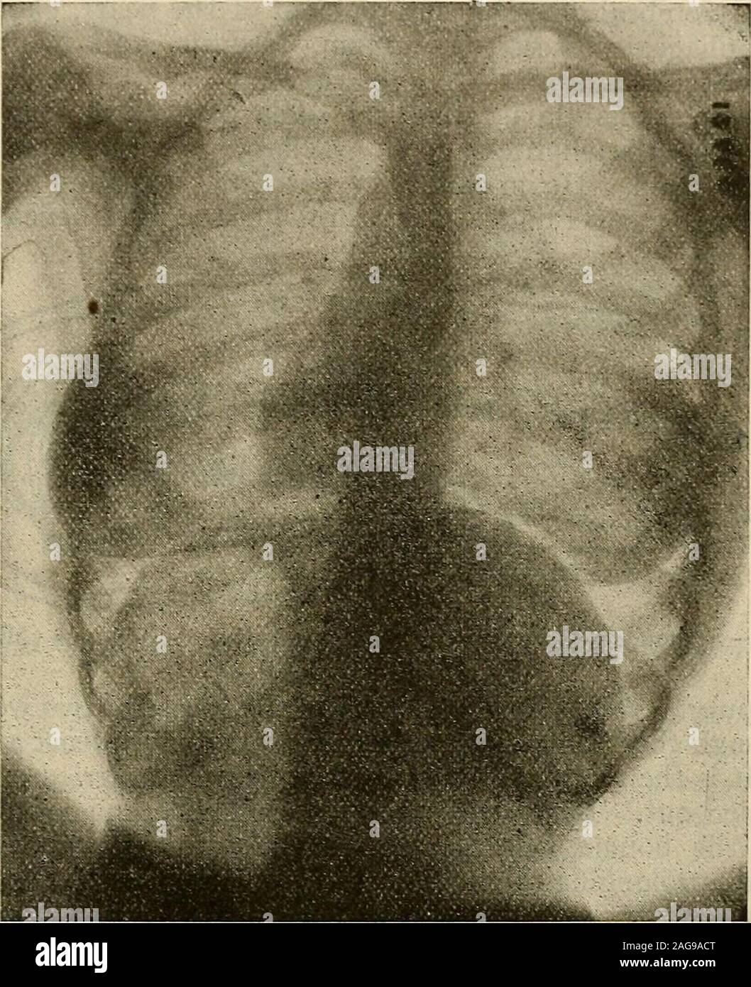 . Modern surgery, general and operative. heredin the dilated gullet ...