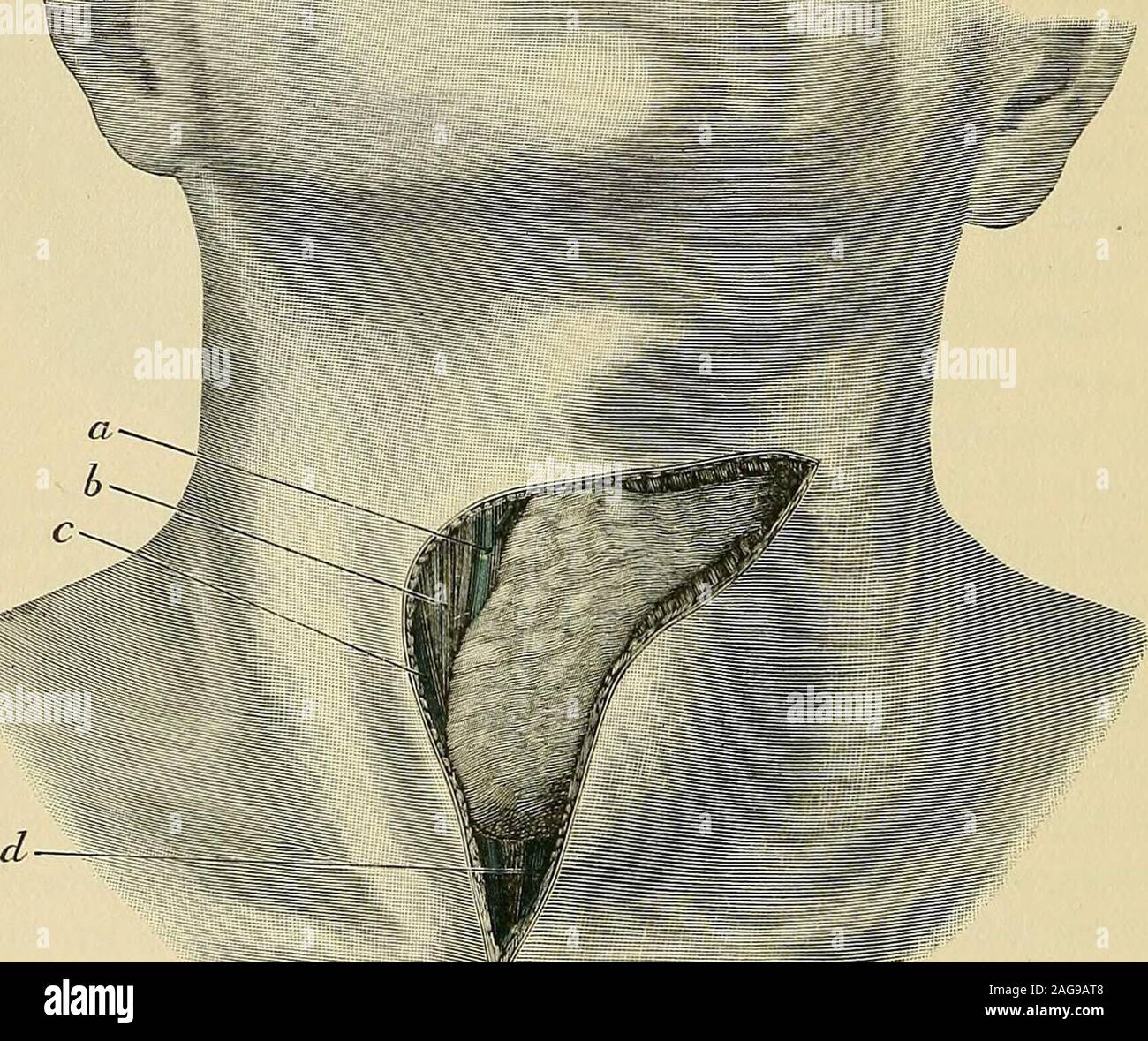 . Operative surgery. Fig. 886.—The ligaturing of thearteria thyroidea ...