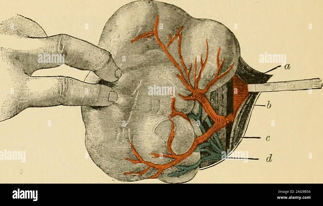 . Operative surgery. -:^V Fig. 884.—The ligaturing of superior ...