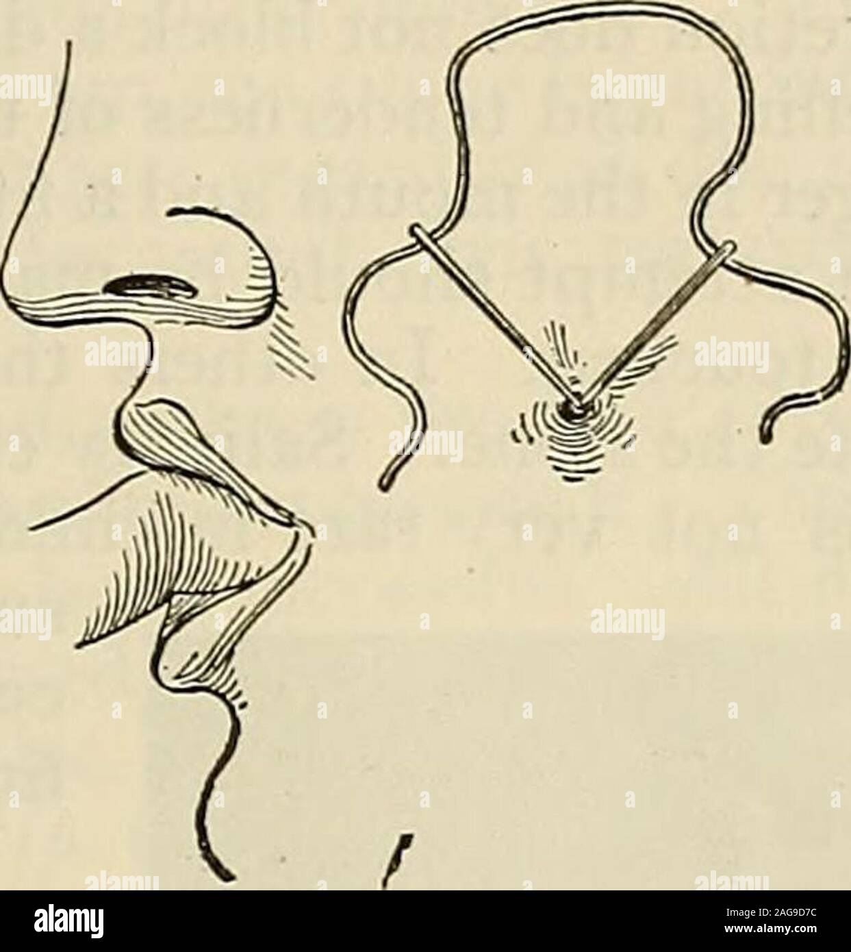 . Modern surgery, general and operative. on ofsaliva, if it does not ...
