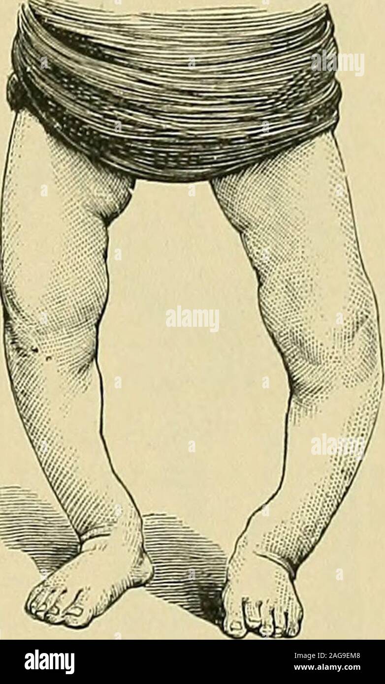 . The diseases of children : medical and surgical. Fig. 40.—Shows how ...