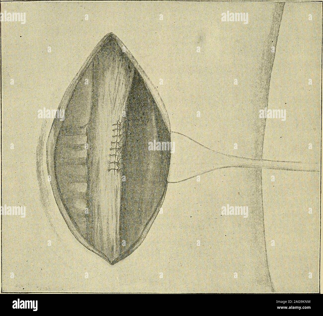 . Operative surgery. Fig. 858.—(Esophageal diverticulum dissected out ...