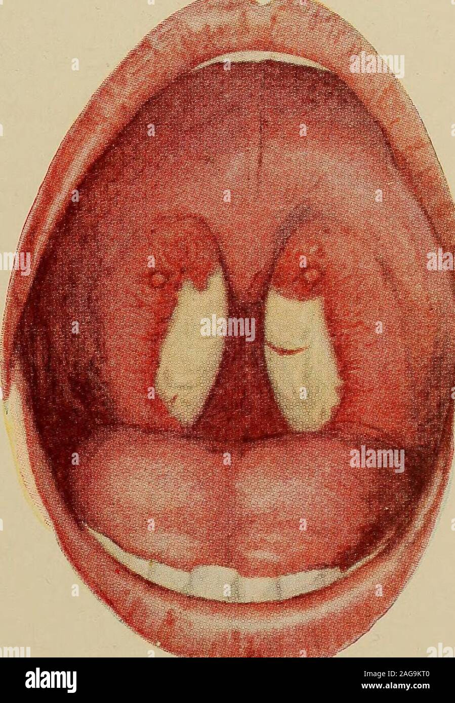 . Diseases of children. Diphtheria of the hps (Hecker, Trumpp, and Abt ...