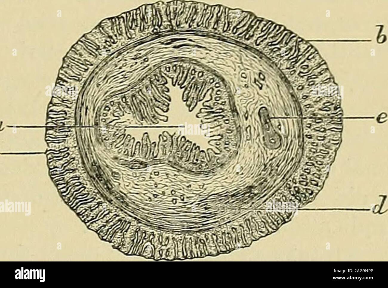 Persistence Of The Omphalomesenteric Duct