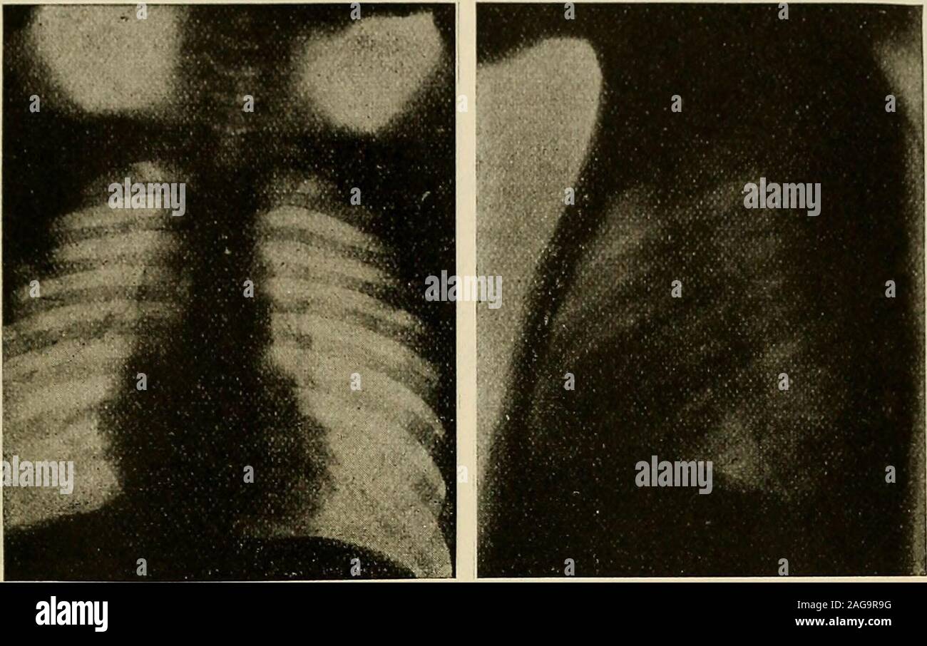 Bronchial rupture hi-res stock photography and images - Alamy