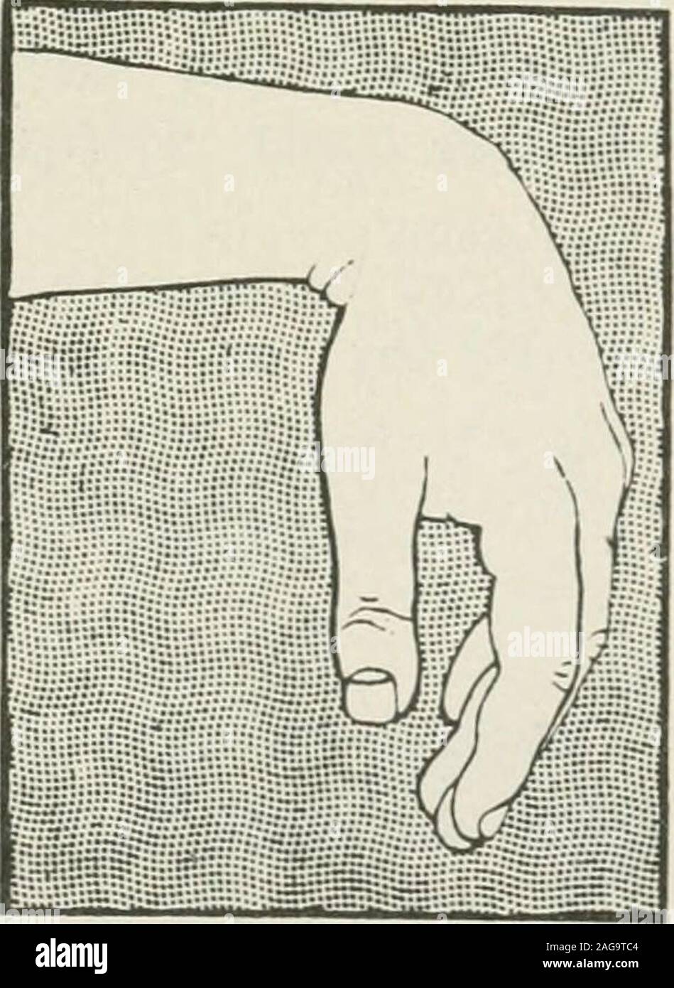 Ulnar bones hi-res stock photography and images - Alamy