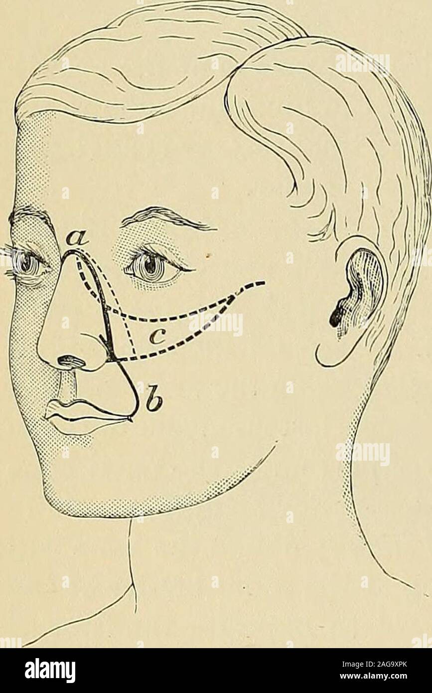 . Operative surgery. of the superior maxilla are then sawed through ...