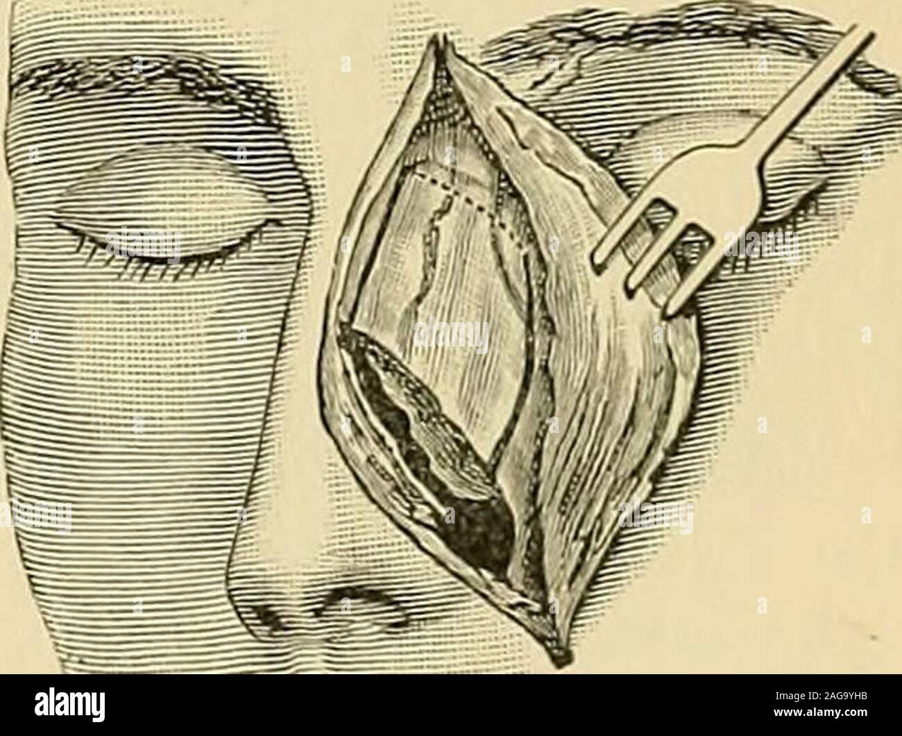 . Operative surgery. Fig. 839.—a Lan