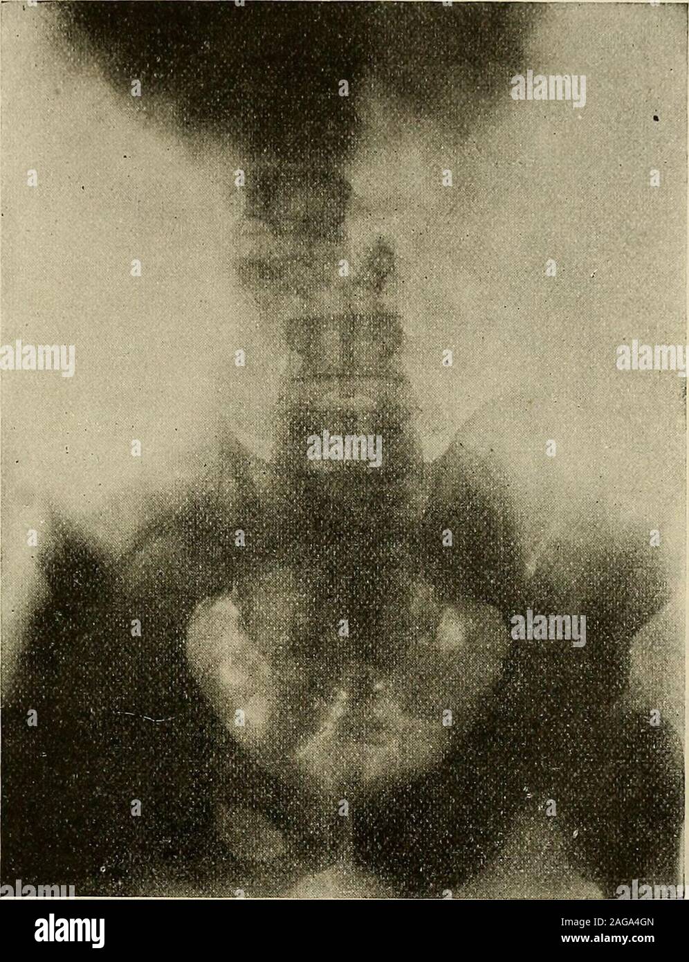 Vertebra fracture spine dislocation hi-res stock photography and images ...