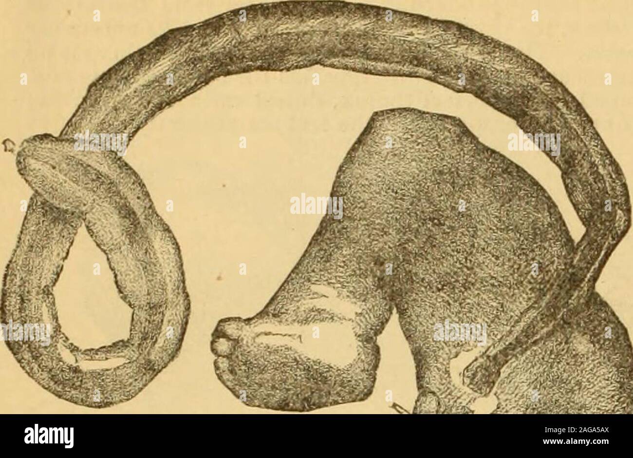 Phocomelia hi-res stock photography and images - Alamy